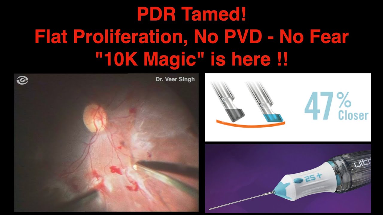 25G Phaco-Vitrectomy for Proliferative Diabetic Retinopathy with flat ...