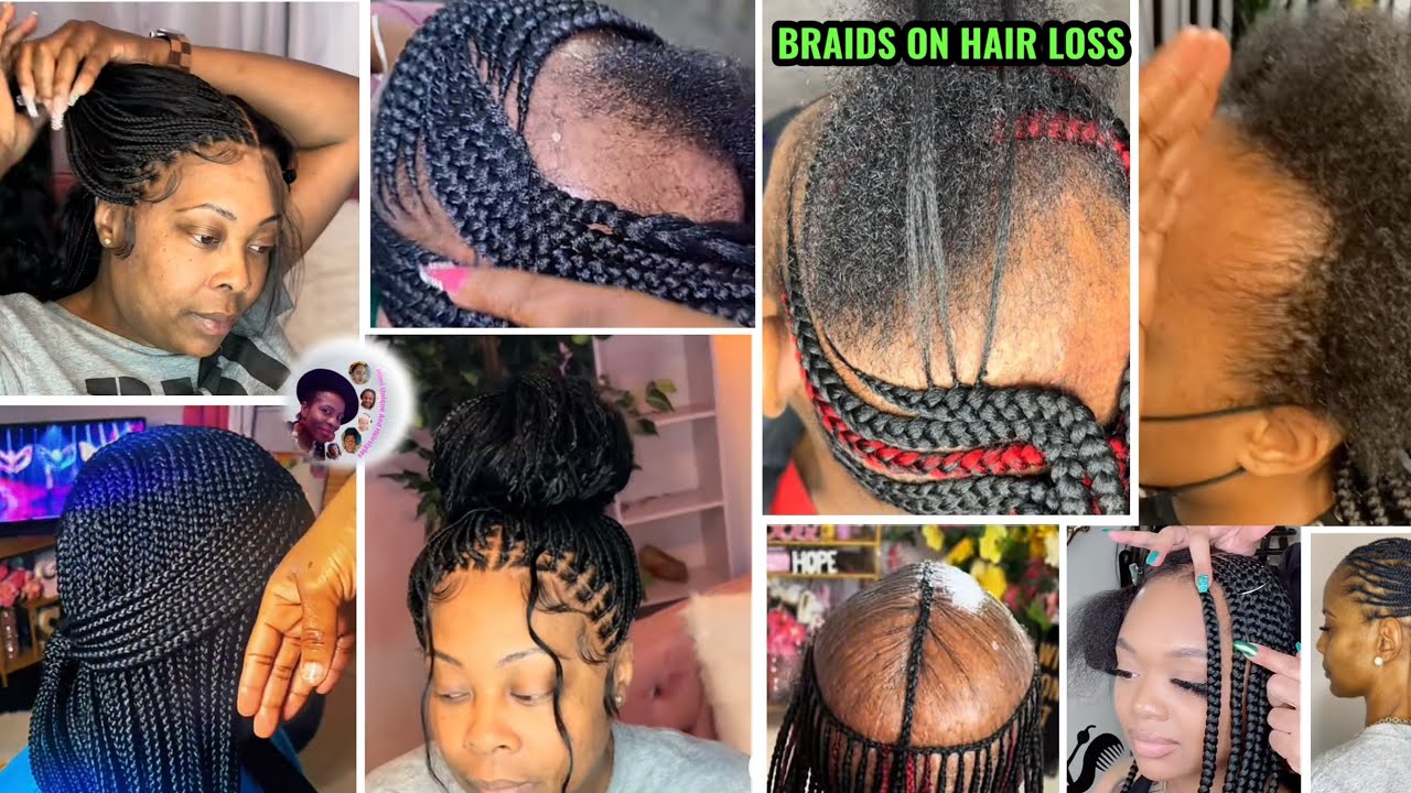 HAIR LOSS? AMAZING HAIRSTYLES IDEAS FOR BLACK WOMEN|ALOPECIA BRAIDS ...