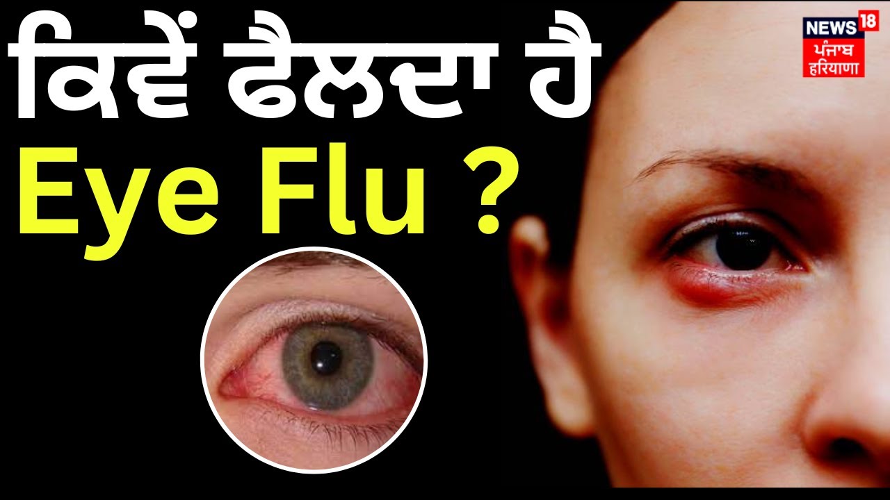 Eye Flu | ਕਿਵੇਂ ਫੈਲਦਾ ਹੈ Eye flu ? | Dr Jagat Ram | Treatment for Eye ...