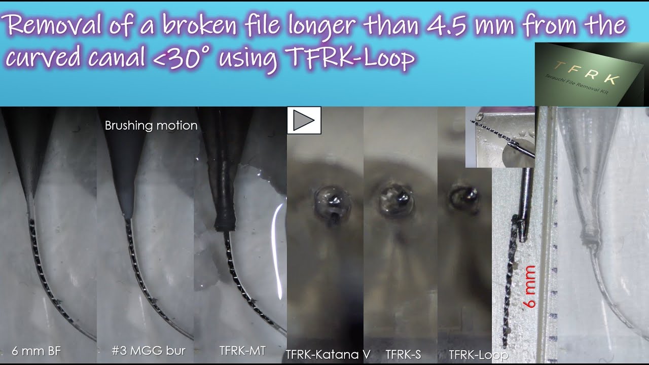 Removal of a broken file longer than 4.5 mm using TFRK-Loop/ループを使った4 ...