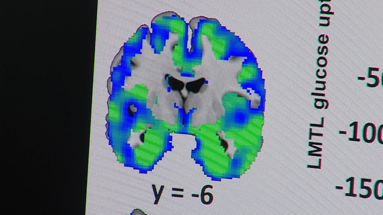 ISU study finds link between insulin resistance and memory loss - YouTube