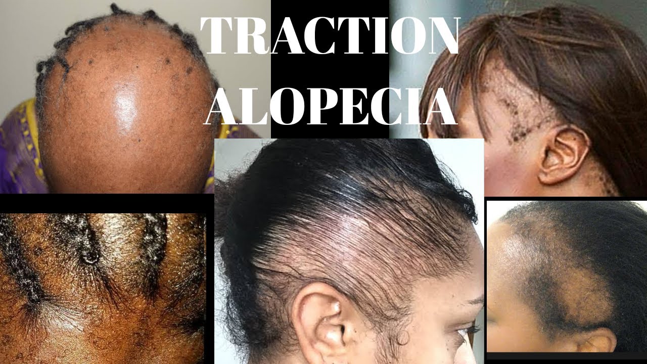 ASHTEMBER | Are your braids giving you traction alopecia? | hair loss ...