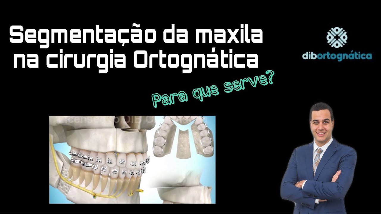 Segmentação Maxilar ou maxila segmentada para que serve na Cirurgia ...