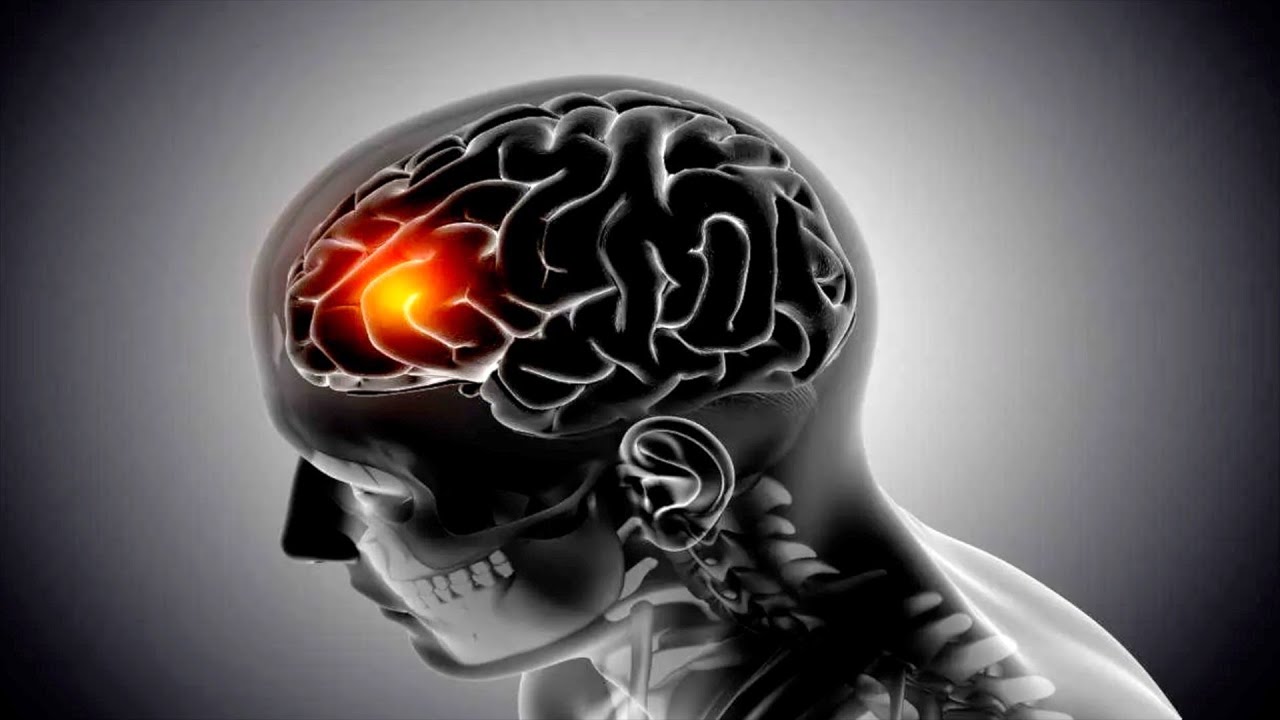Signs of Blood Clot in the Brain, That should Not Be Ignored! - YouTube