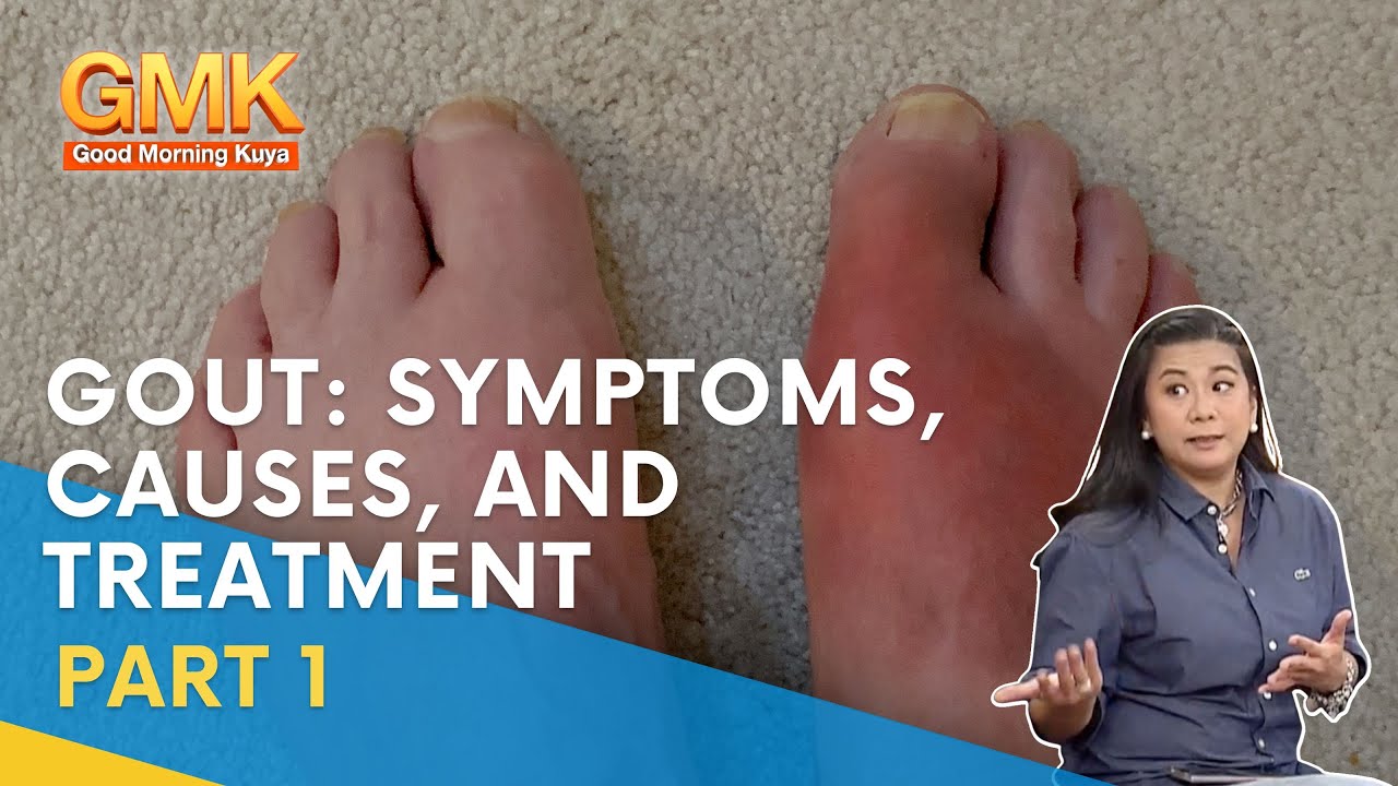 Gout: Symptoms, Causes, and Treatment (Part 1) | Usapang Pangkalusugan ...