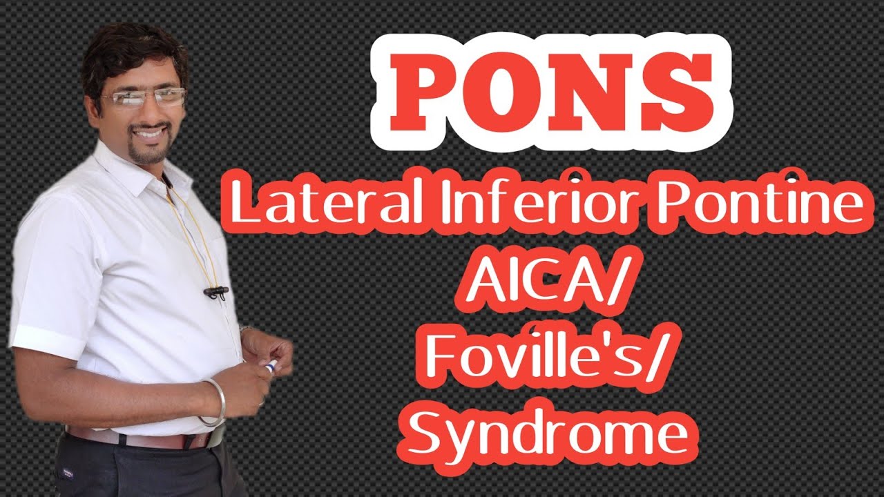 Pons (Part - 6) Lateral inferior pontine syndrome/ AICA syndrome ...