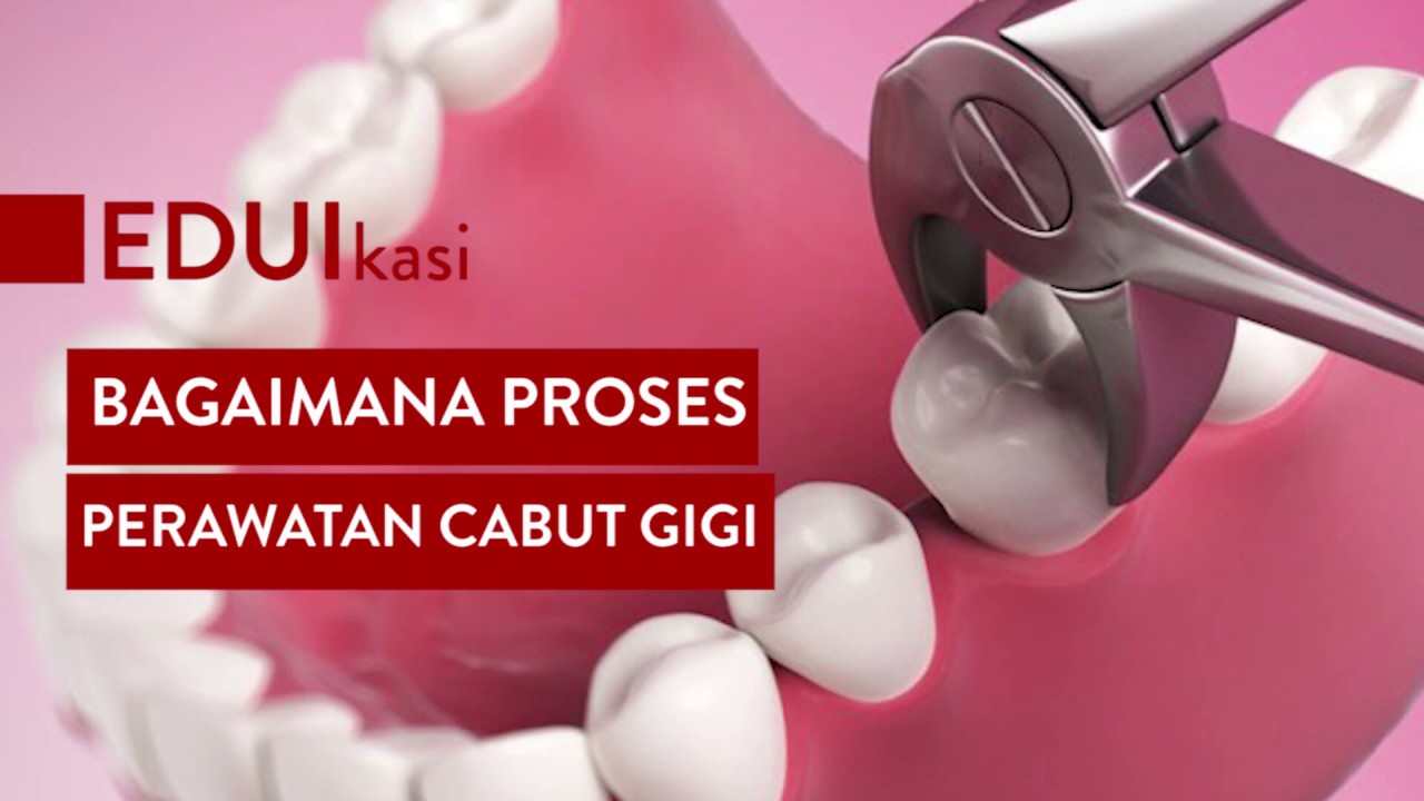 JANGAN DIBUKA !! INILAH PROSES CABUT GIGI !! - YouTube
