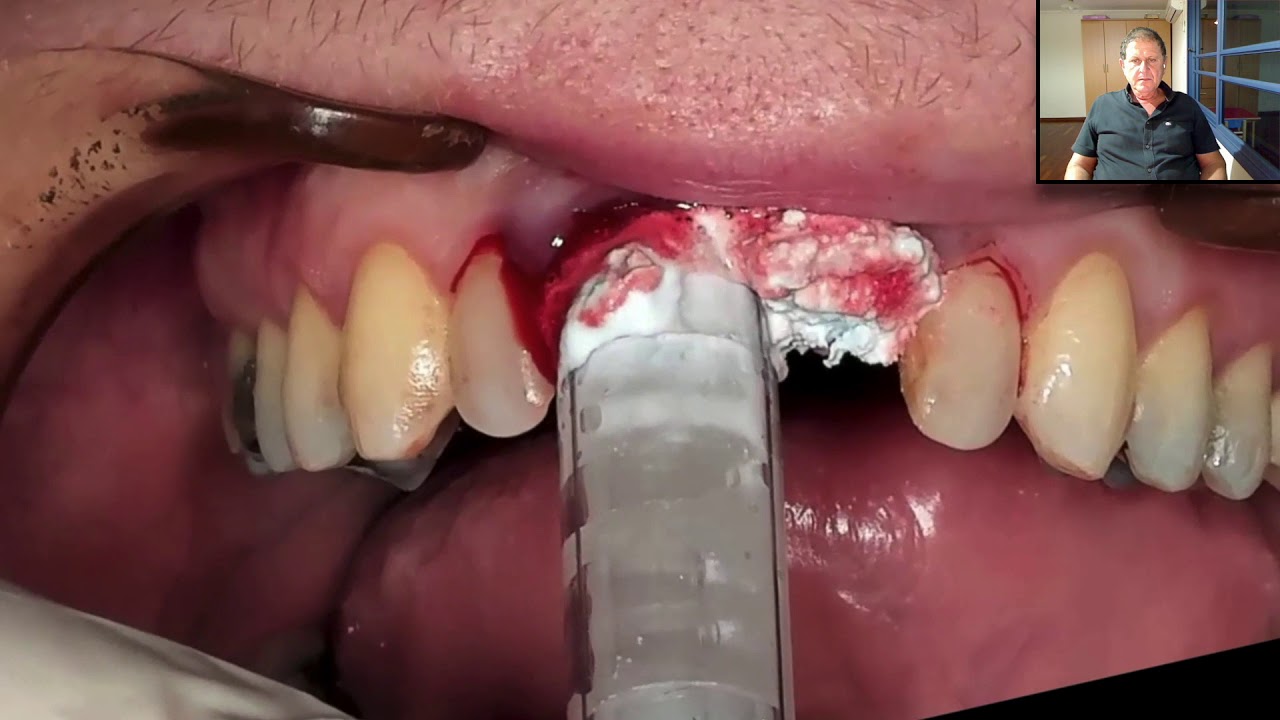Augma bone cements protocols with Ora aid wound dressing webinar 2020 ...