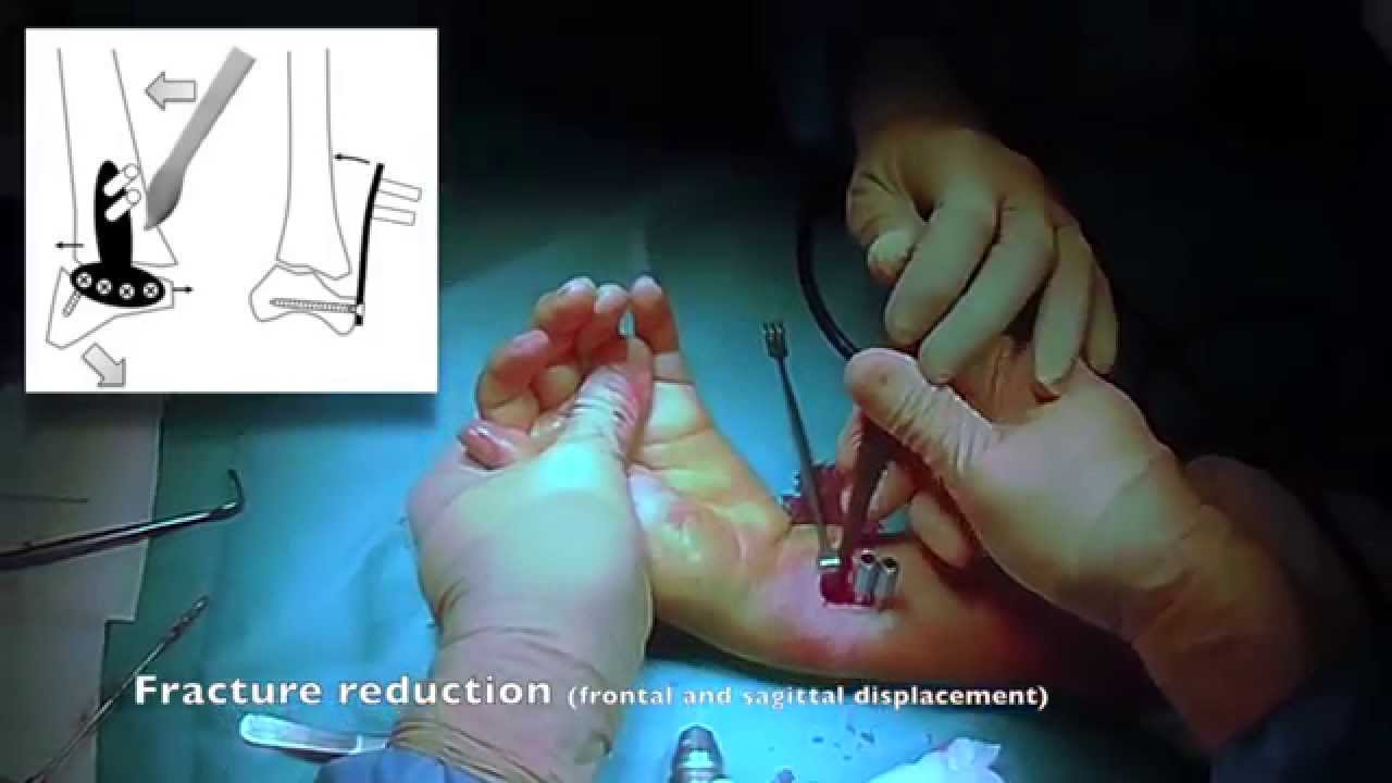 Minimally invasive distal radius fracture fixation - YouTube