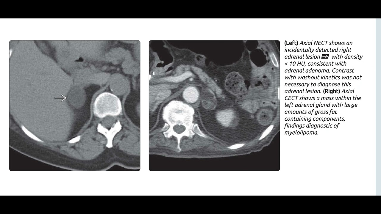Genitourinary imaging radiology(1) - YouTube