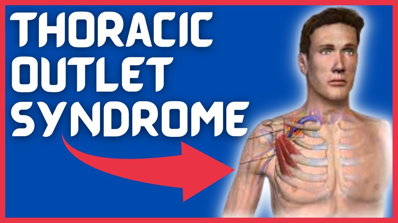 Thoracic Outlet Syndrome: Symptoms, Causes & Treatments - YouTube