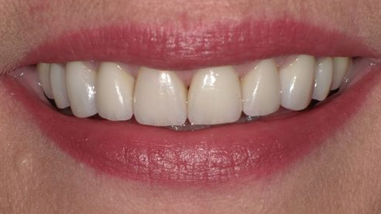 Como Fiz Para Ficar 3 Anos Usando Prótese Dentária? Roach Prótese ...
