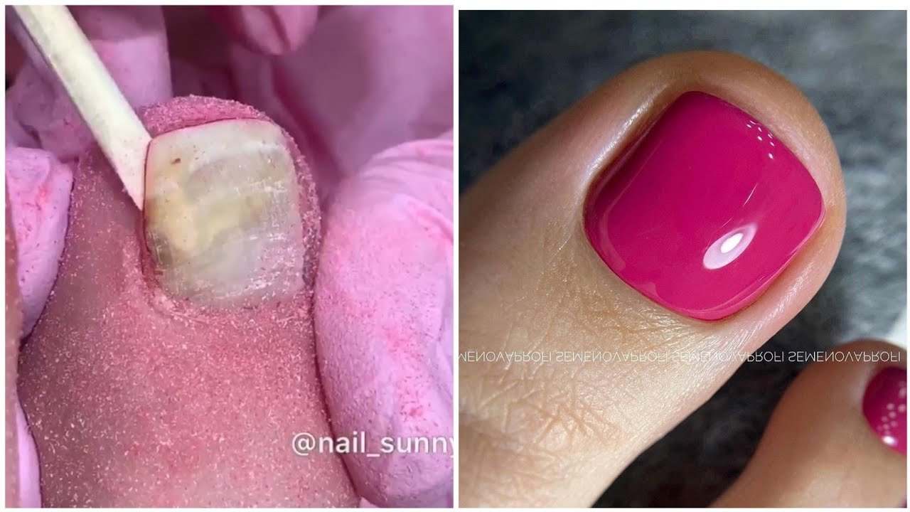 Most Satisfying Pedicure Transformation 😱 best nail polish for toes ...