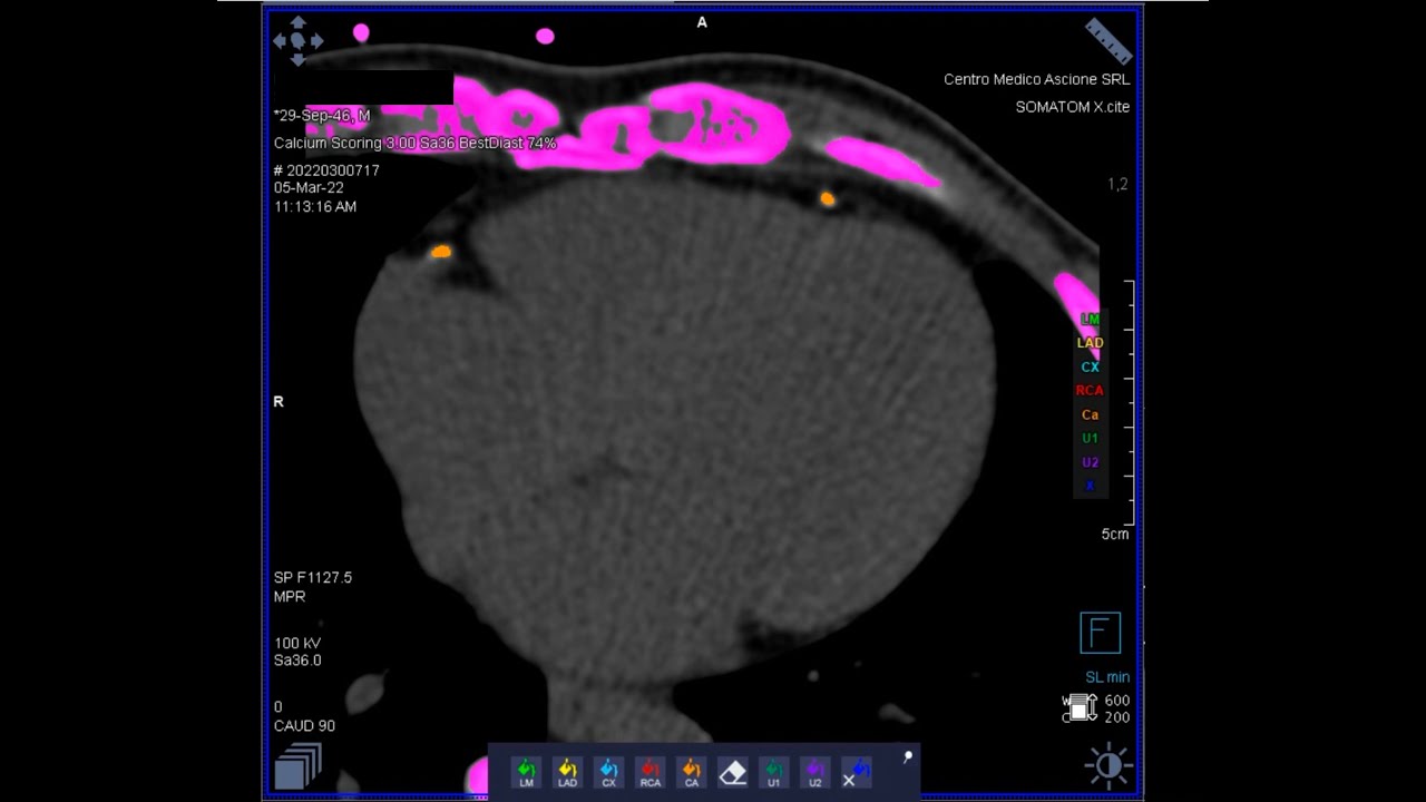 How to perform a cardiac CT scan for TAVI - YouTube