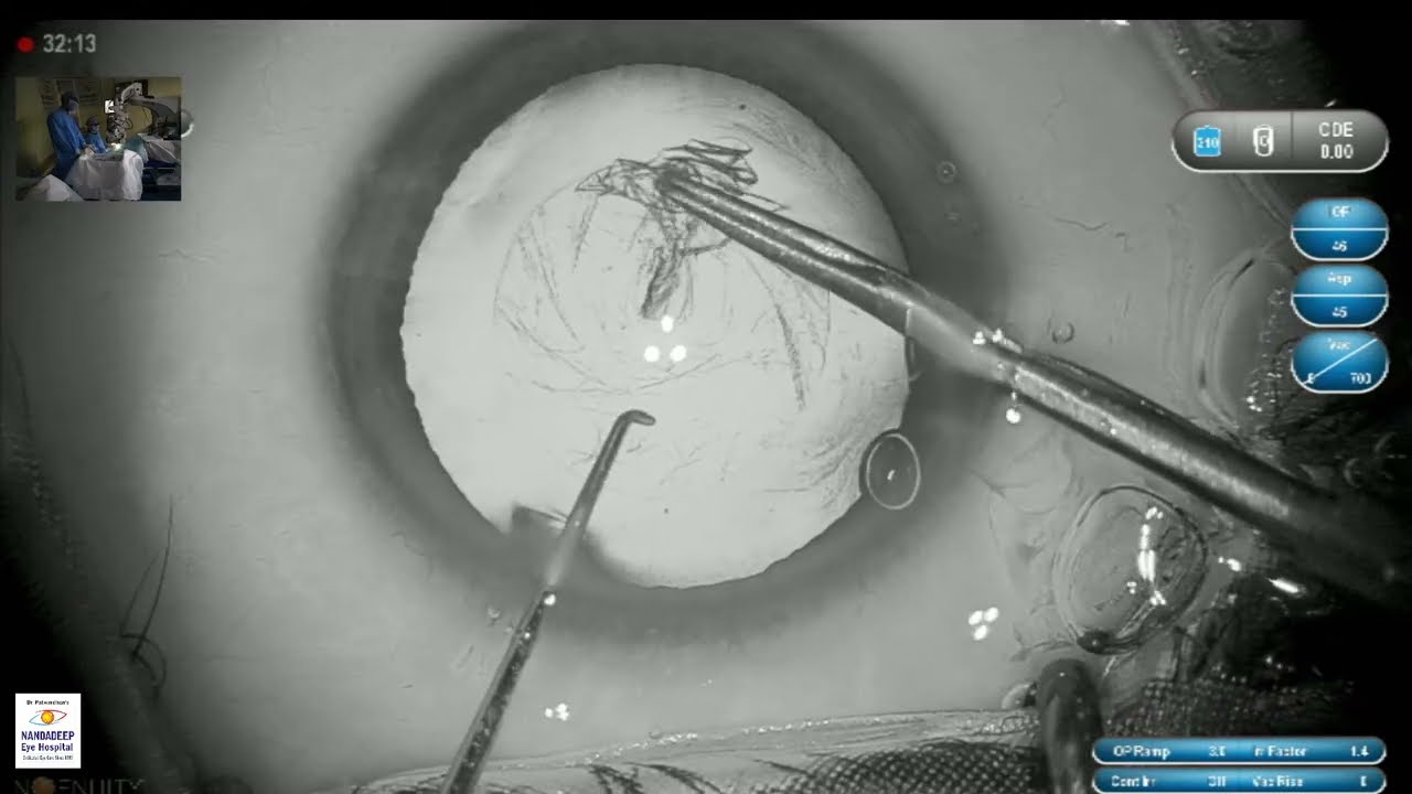 Soft cataract Rayner IOL Dr Sourabh D Patwardhan 3D live Phaco surgery ...