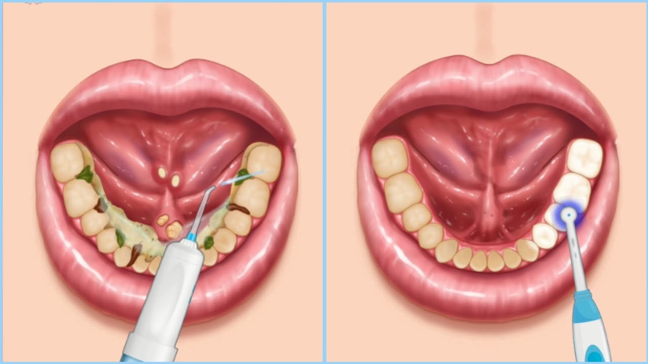 PLAQUE ATTACK | DENTAL CARE TRANSFORMATION ANIMATION - YouTube