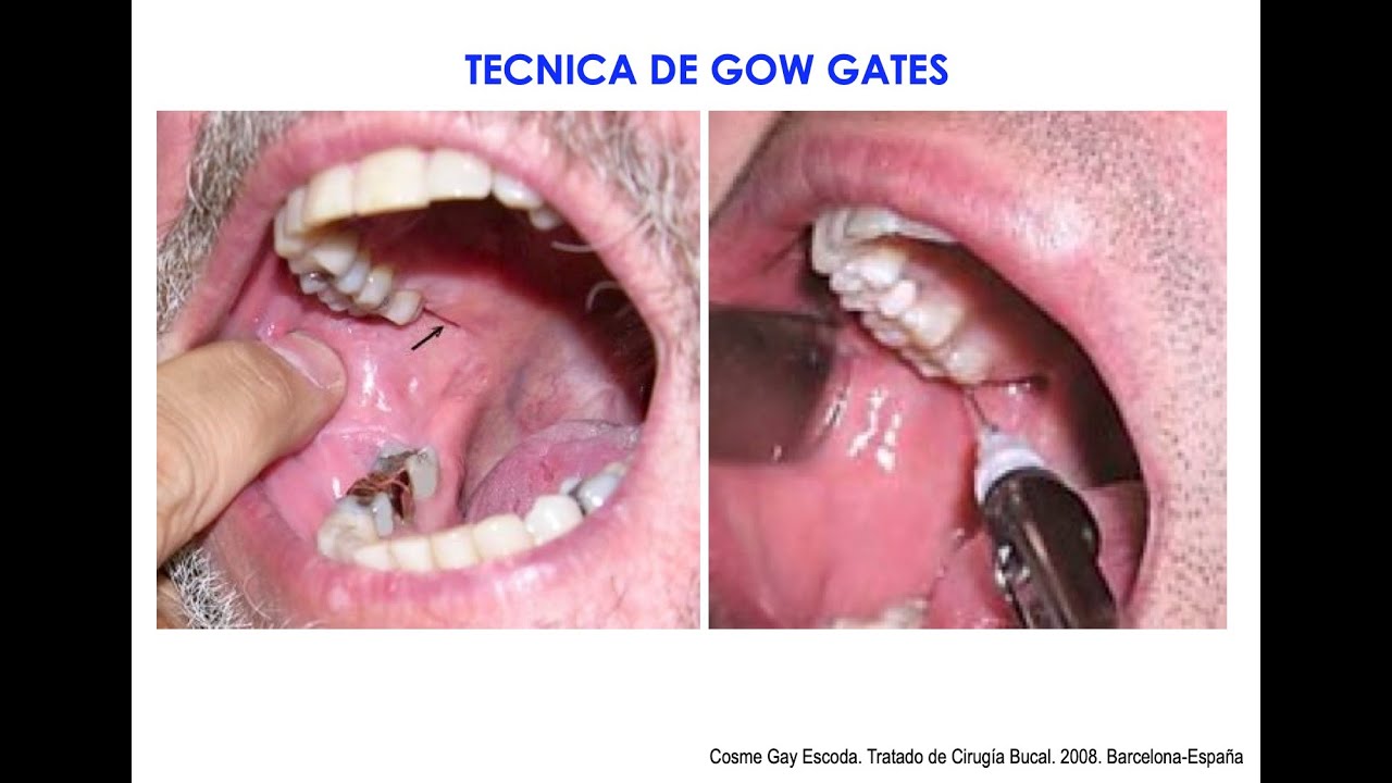 Anestesia Gow Gates Boca cerrada y Mentoniana para Odontólogos - YouTube