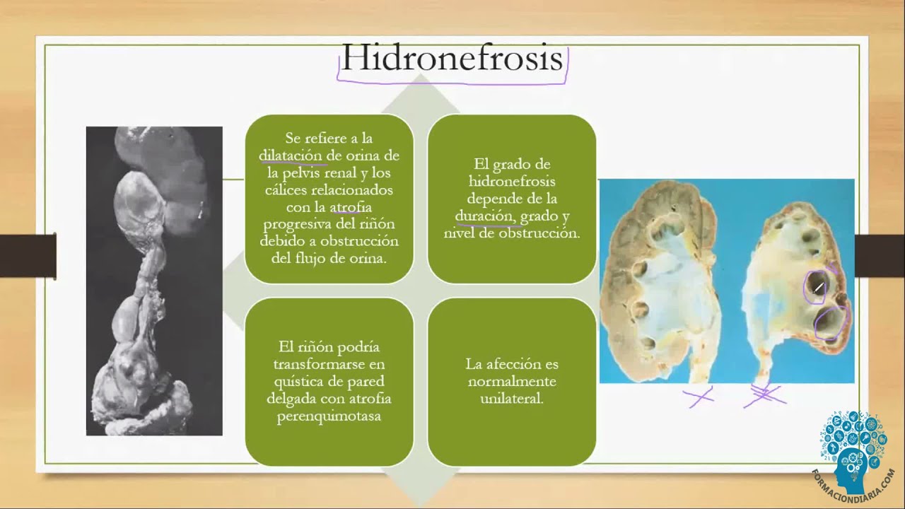 HIDRONEFROSIS - YouTube