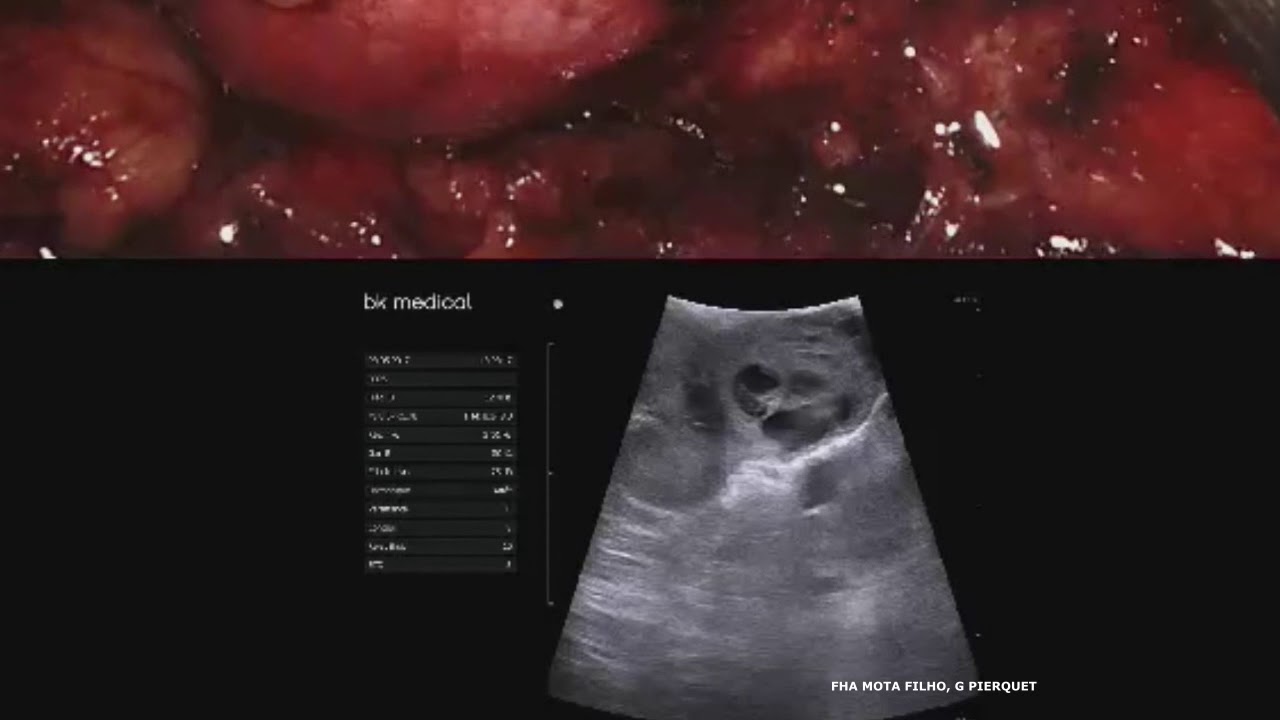 Robotic Retroperitoneal Left Partial Nephrectomy with Ultrasound ...
