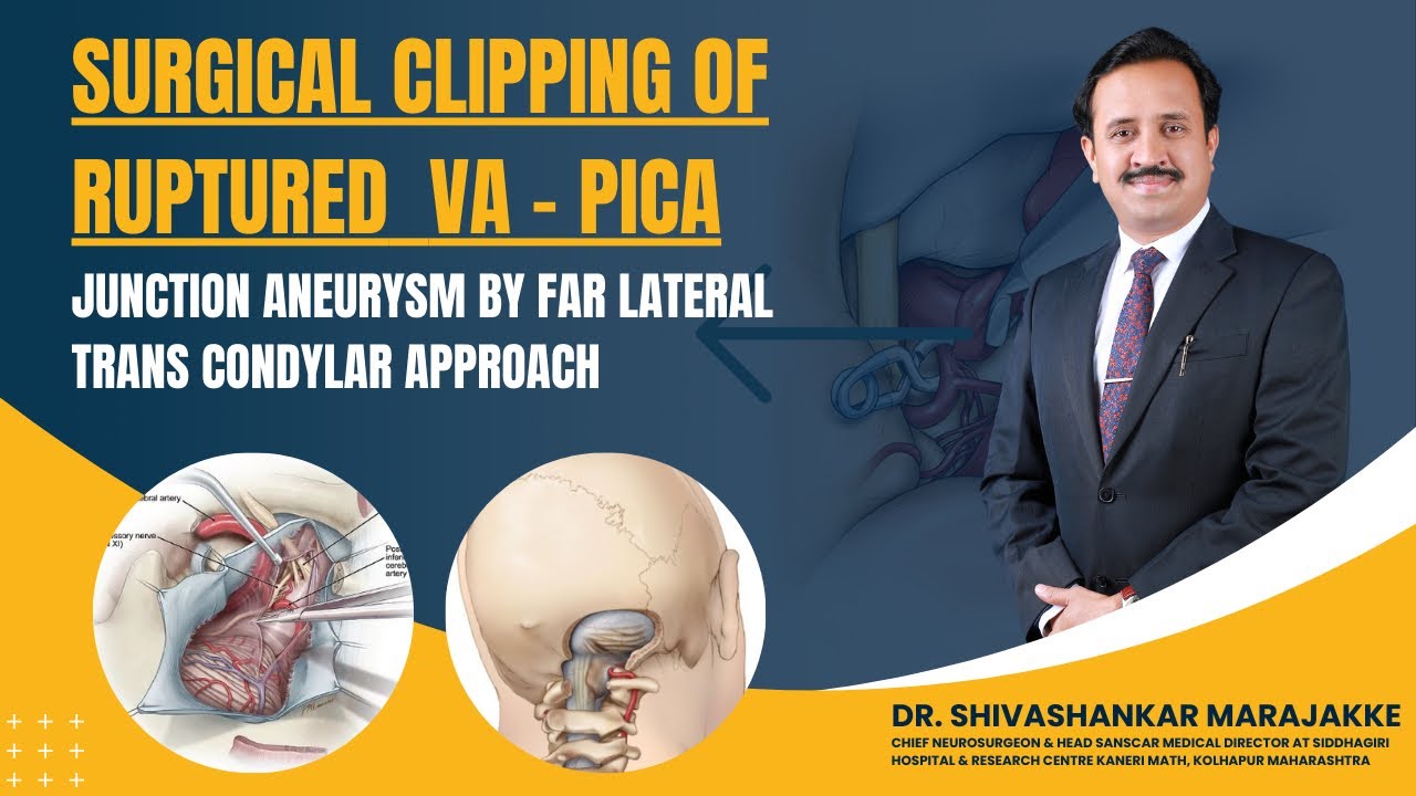 SURGICAL CLIPPING OF #PICA(POSTERIOR INFERIOR CEREBELLAR ARTERY ...