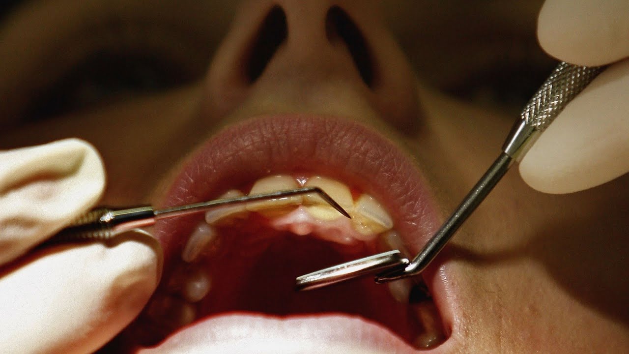 Dientes rotos o astillados, ¿qué se debe hacer para recuperar la salud ...