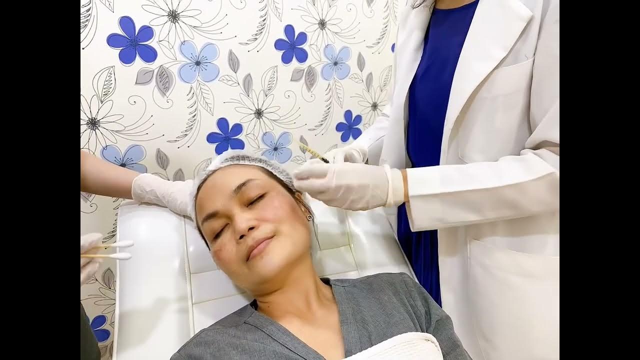 Prp รักษาฝ้า by regenlab - YouTube