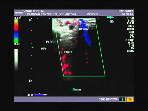 perforator veins of the right leg-1b - YouTube