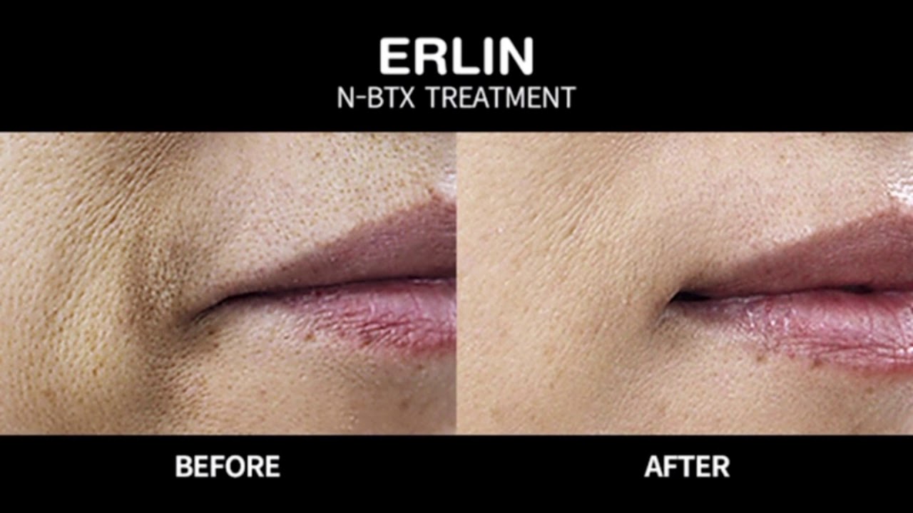[ERLIN] Anti Wrinkle Serum Kit - YouTube