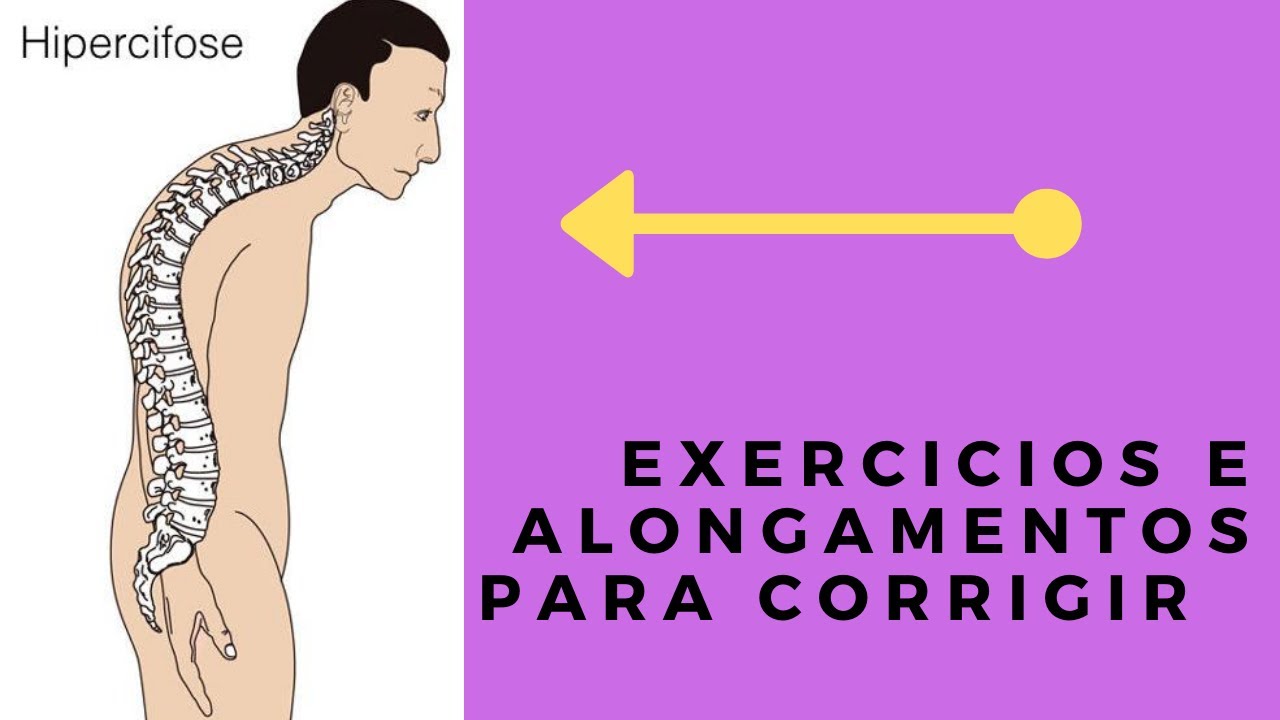 EXERCÍCIOS E ALONGAMENTOS PARA CORRIGIR A CIFOSE TORÁCICA - YouTube