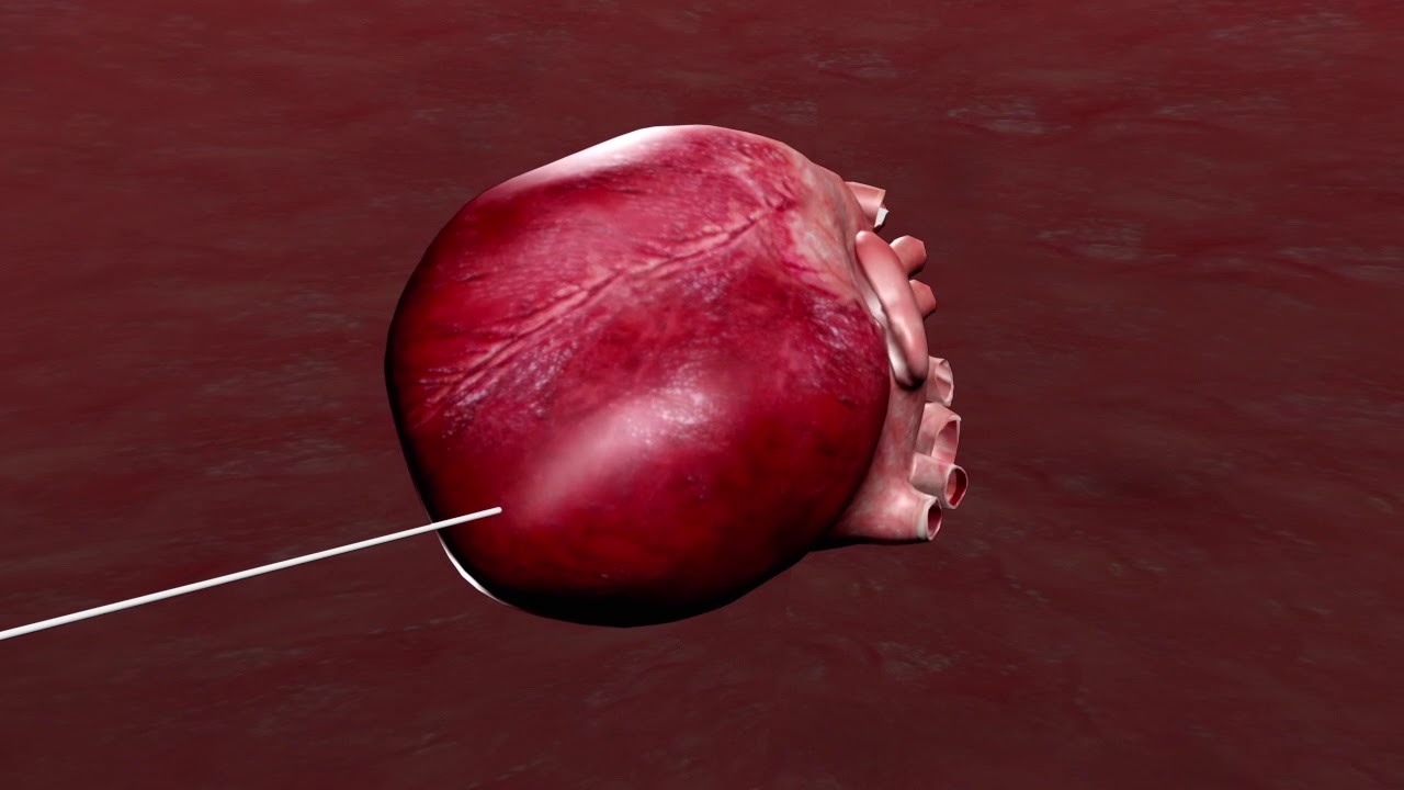 Fetal Balloon Aortic Valvuloplasty - YouTube