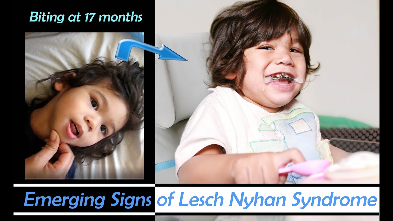 Early Emerging Signs of Lesch Nyhan Syndrome in Davey---Biting Started ...