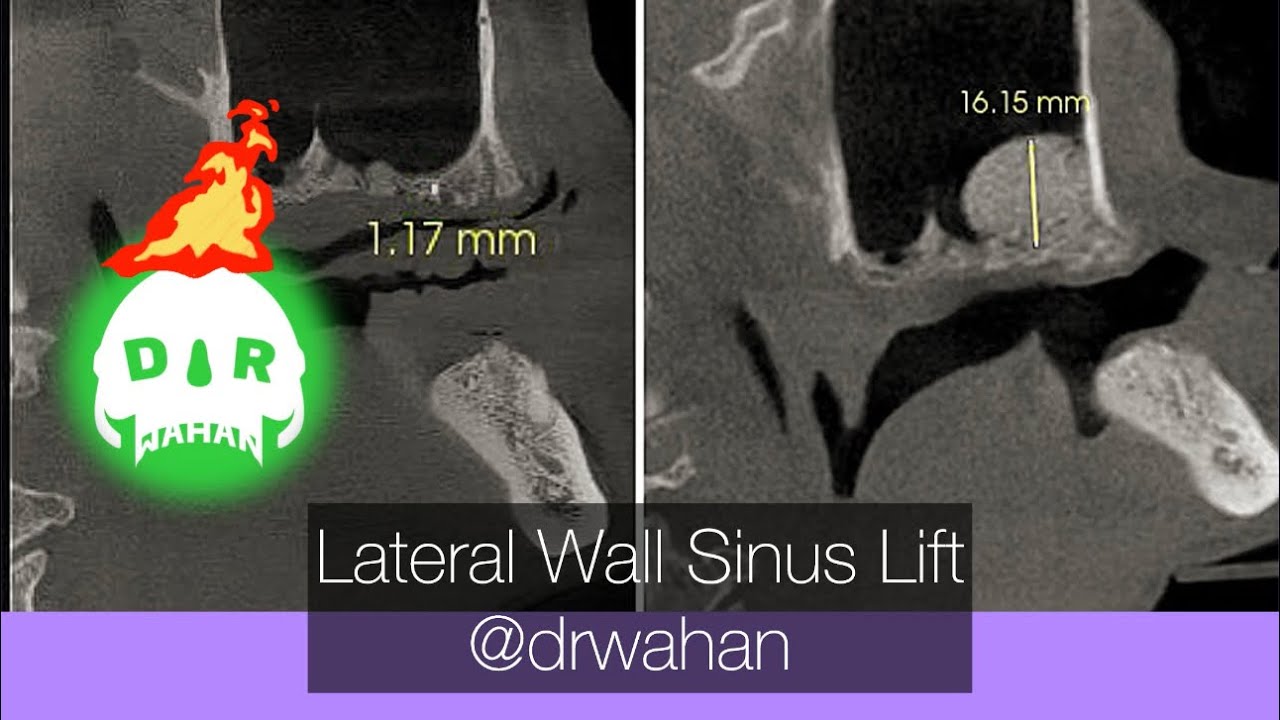 Black and White Version: Later Wall Sinus Lift 1mm to 16mm @drwahan ...