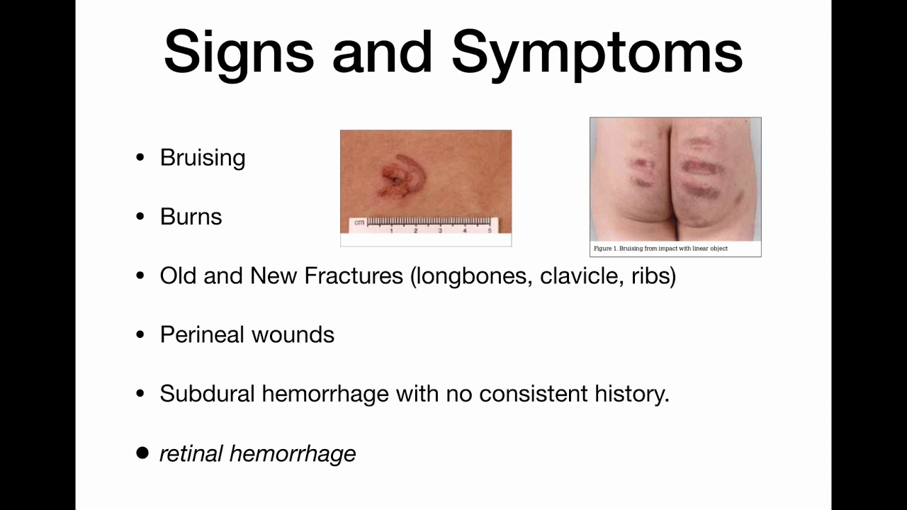 Episode 21: Pediatric Non-Accidental Injury - YouTube