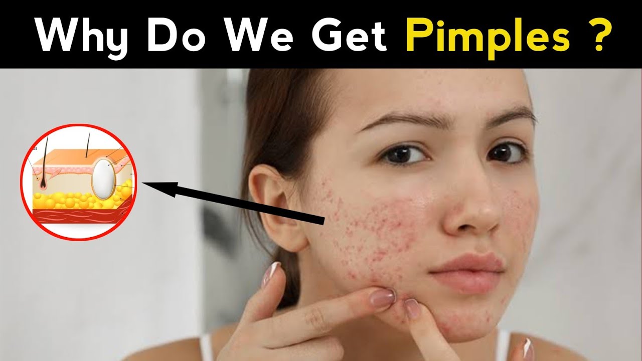 Why Do We Get Pimples || How To Remove Pimples || Acne Treatment - YouTube
