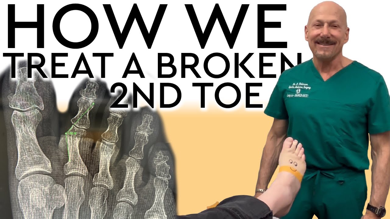 How We Treat A Broken 2nd Toe - YouTube