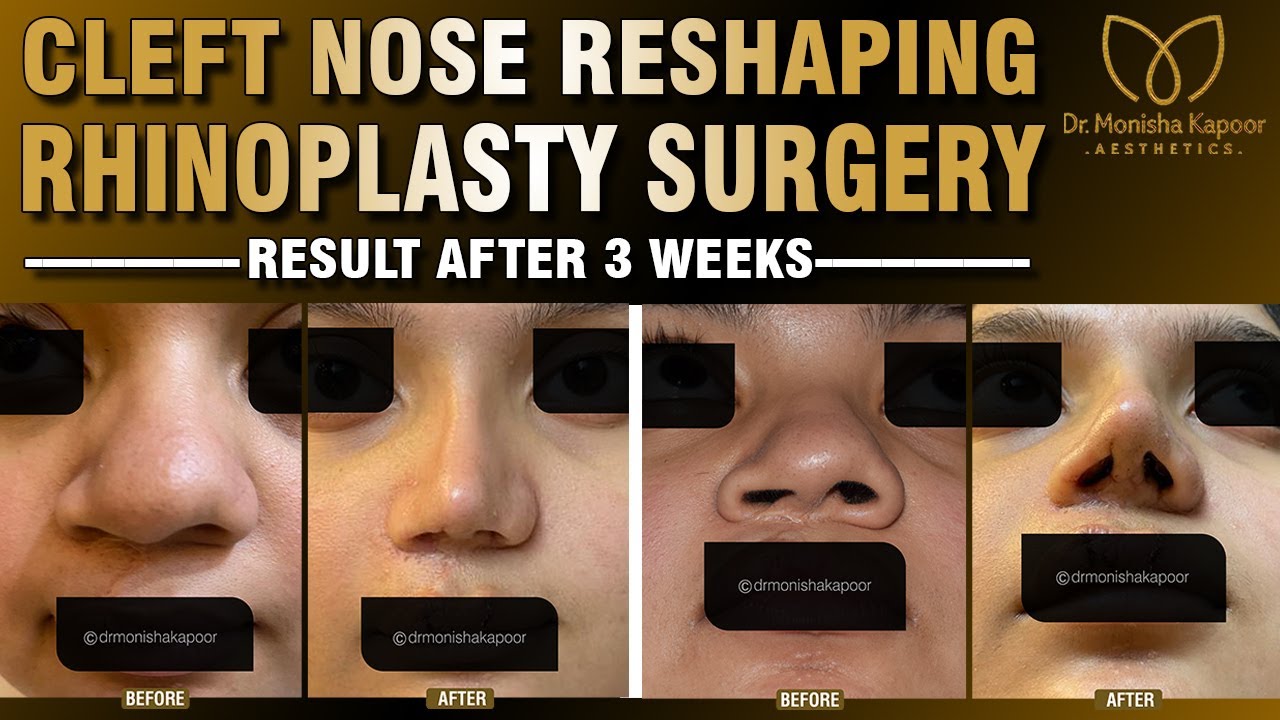 Cleft Nose Reshaping Rhinoplasty | Result After 3 Weeks - YouTube