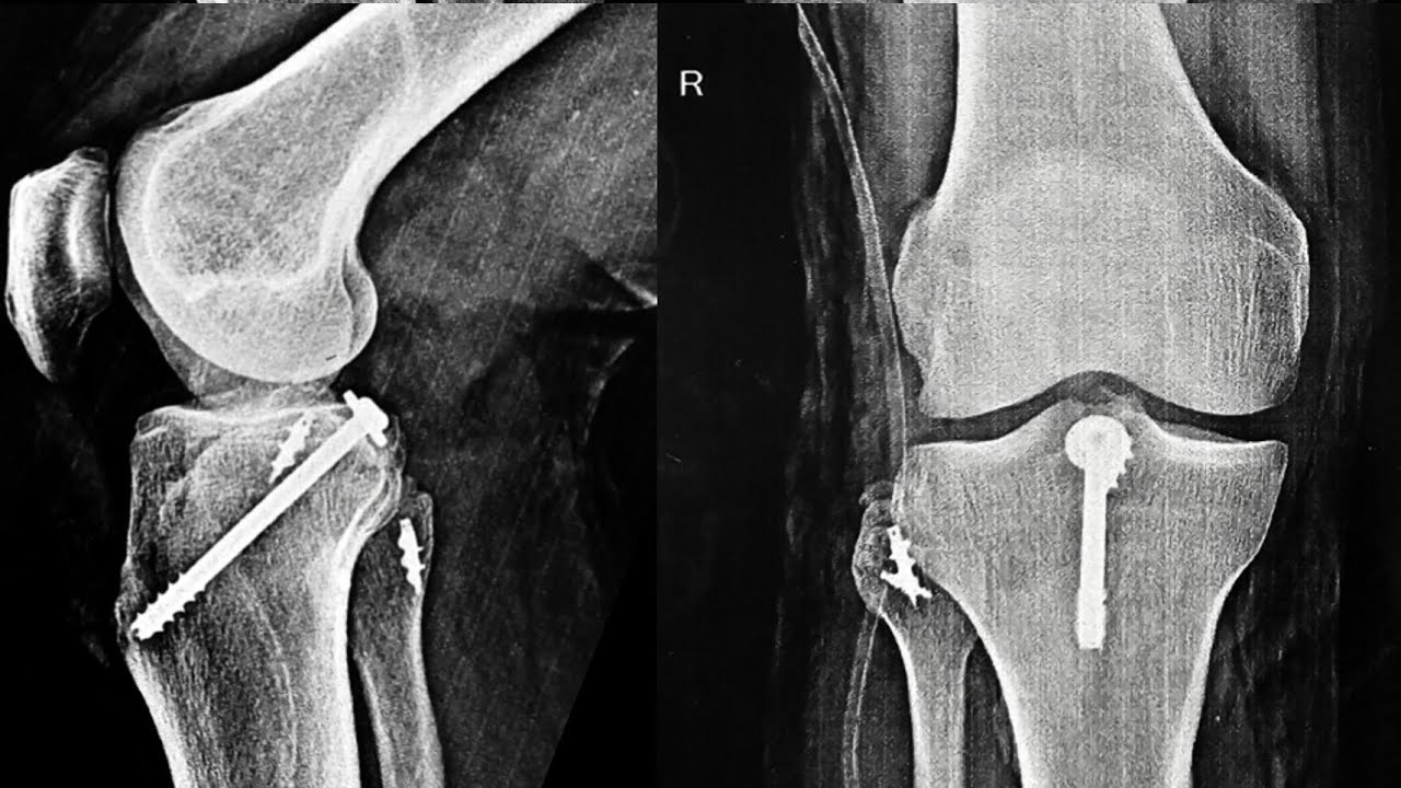 Mini Posterior approach for PCL avulsion fixation. Arthroscopic vs open ...
