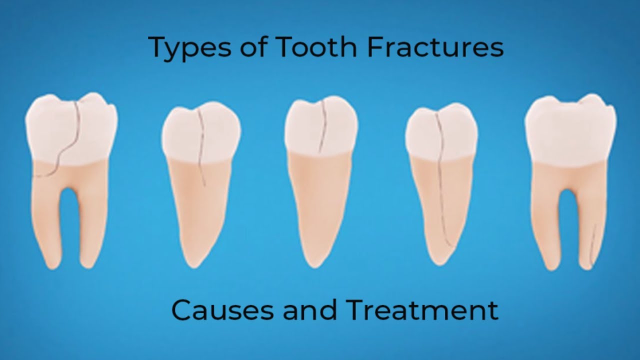 Types of tooth fracture with causes and treatment - YouTube