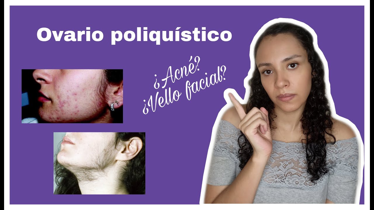 SÍNDROME DE OVARIO POLIQUÍSTICO / VELLO FACIAL EN MUJERES - YouTube