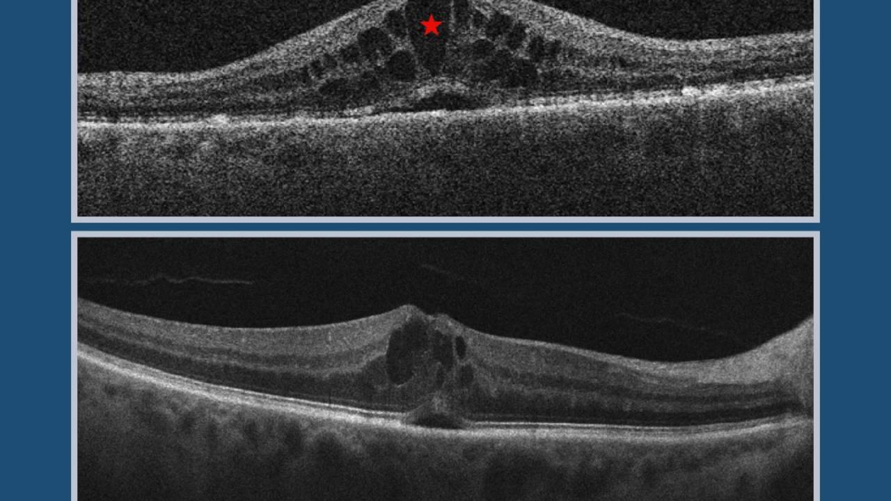 Intraretinal Fluid (IRF): Empty Cysts vs. IRF: Speckled - YouTube