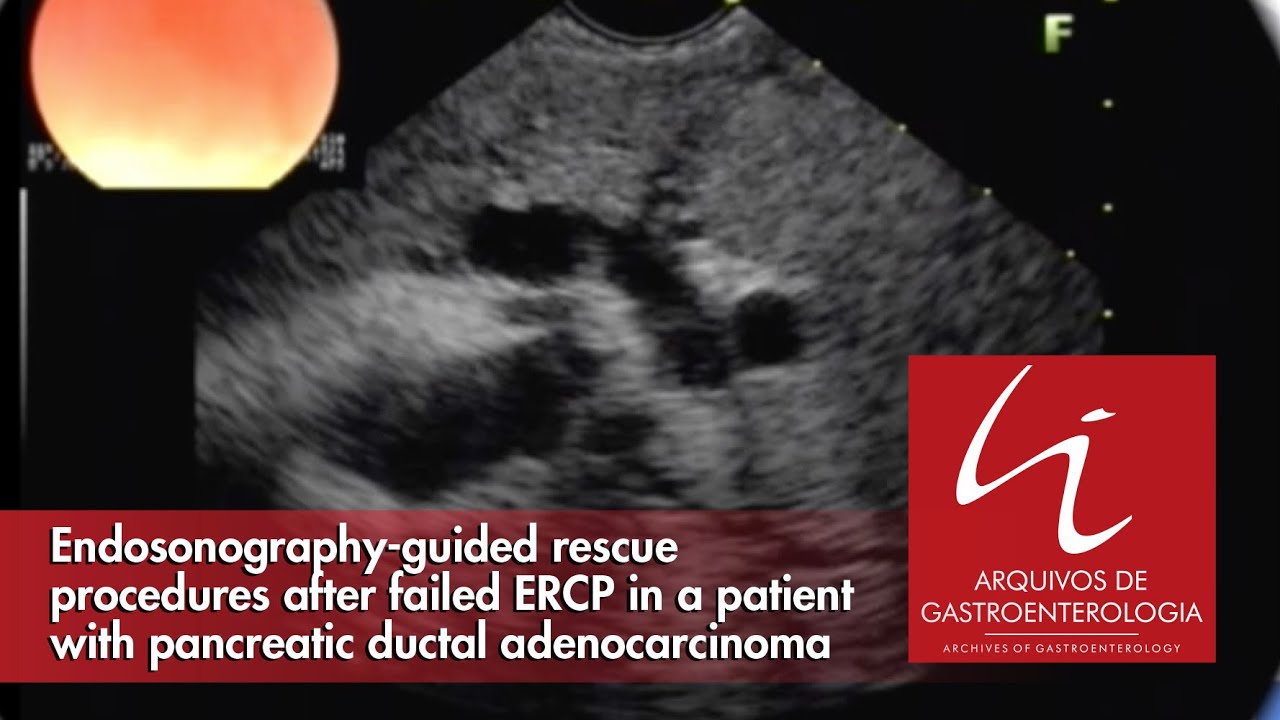 Endosonography-guided rescue procedures after failed ERCP in a patient ...