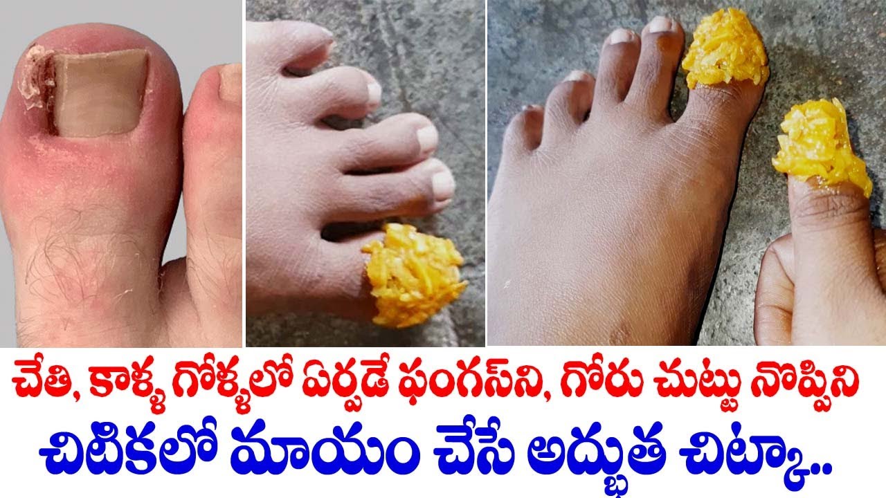 గోరు చుట్టు నొప్పి,ఫంగస్ మాయం | Fungal Nail Infection | Nail Fungus ...