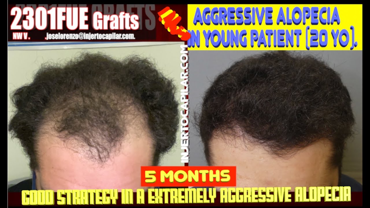 2301Grafts.Aggressive AGA in young patient(21yo).Awesome improvement w ...