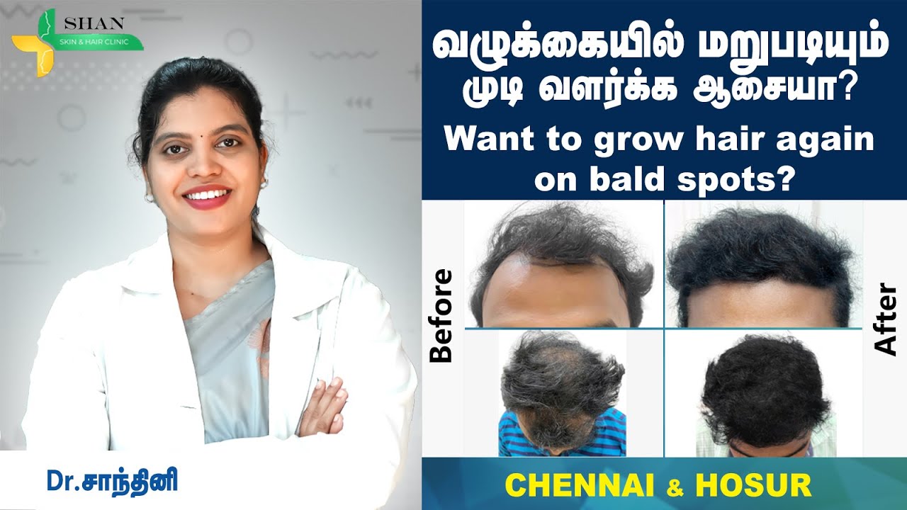 Hair transplant 10 months results | Check out | Dr Shanthini - YouTube