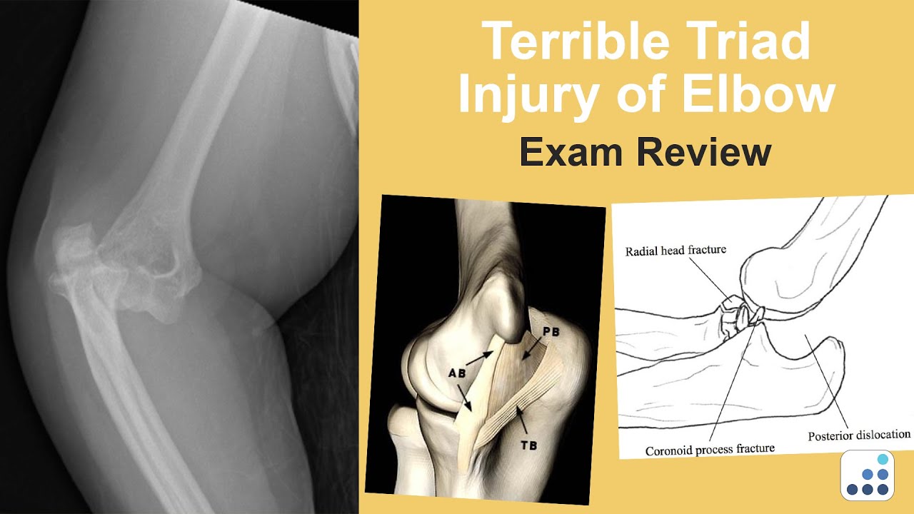 Terrible Triad Injury of Elbow Exam Review - Mark S. Cohen, MD - YouTube