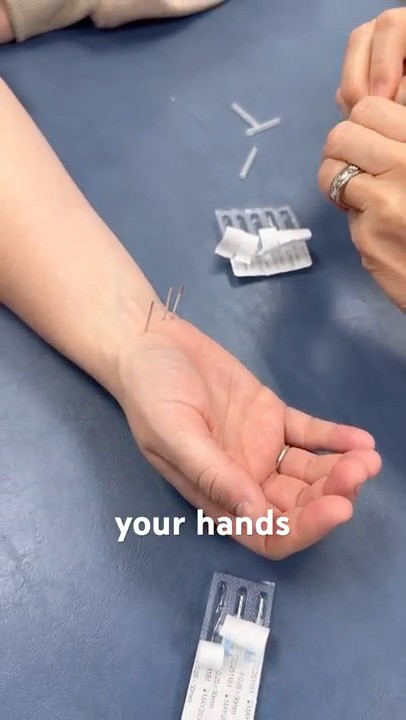 Freezing Hands & Wrist Pain Relief: Dry Needling Wizard Magic - YouTube