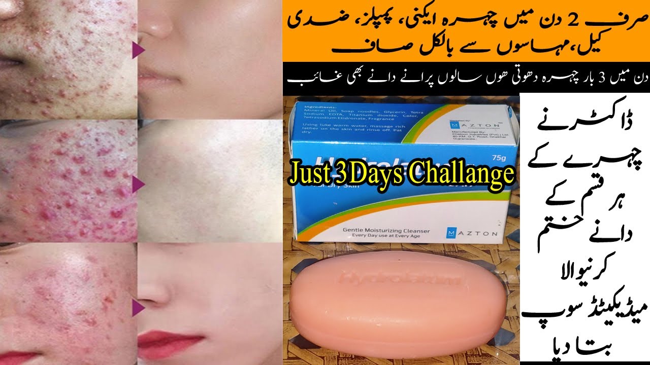 Medicated Hydrolatum Acne Soap Review | How To Remove Pimples Overnight ...