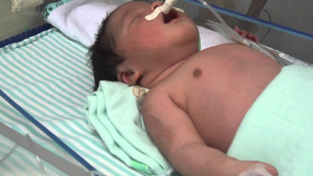 aspiraçaõ de mecônio - YouTube