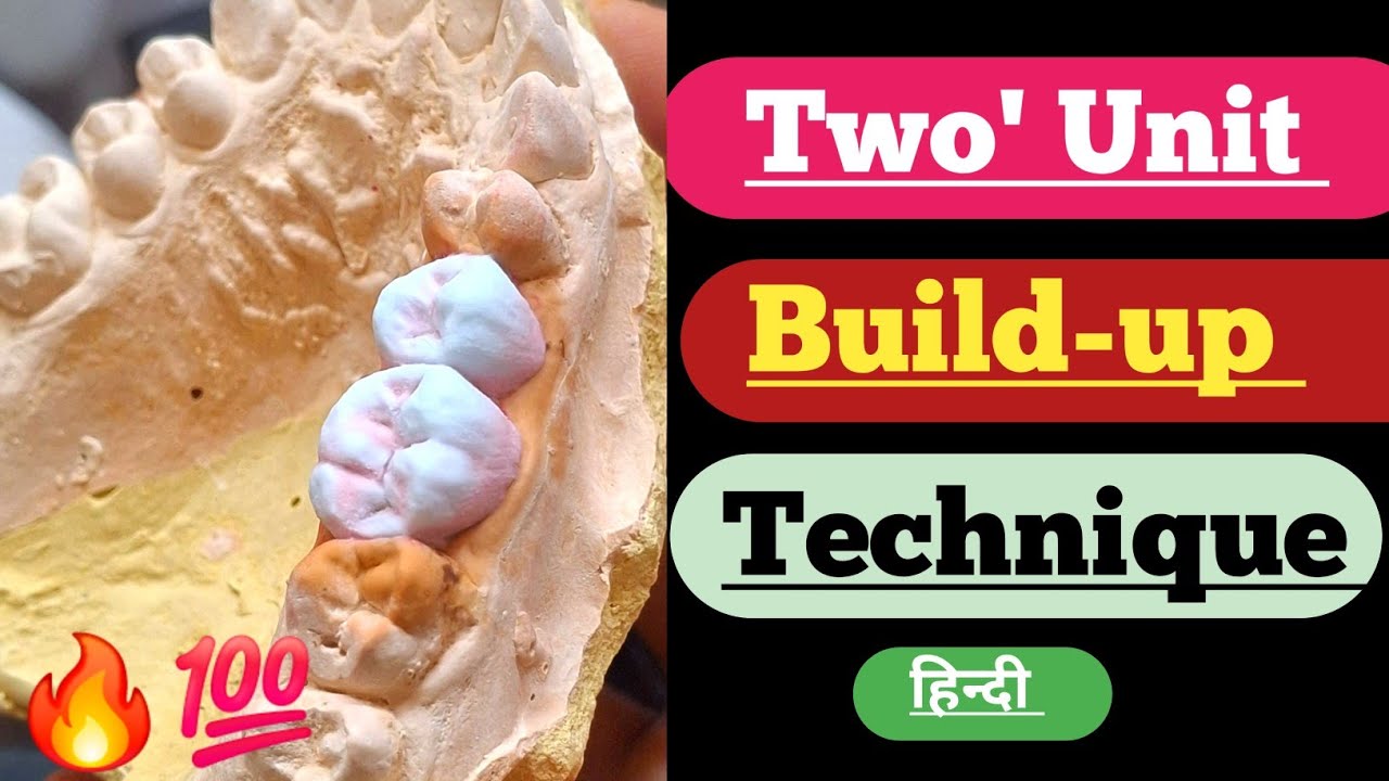 Two' Unit Build up technique| Upper ceramic| dental technician video ...