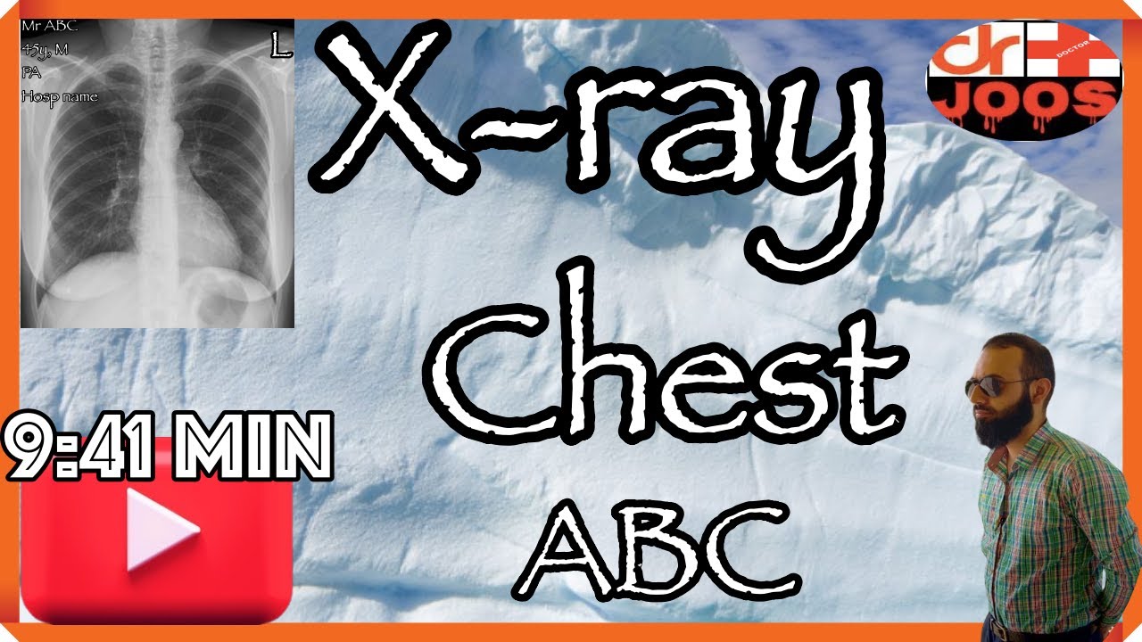 Video 1/ ABC of chest x-ray/ Xray Made easy/ The easiest way to ...